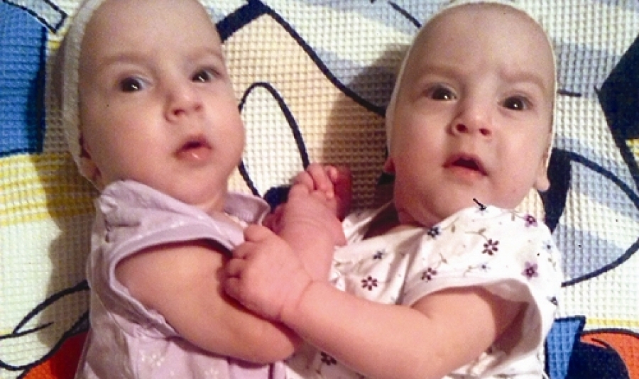 First Georgian conjoined twins are in need of urgent help - GeorgianJournal